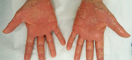 Stéphane, 40 ans, Lésions et desquamations des pieds et des mains en ...